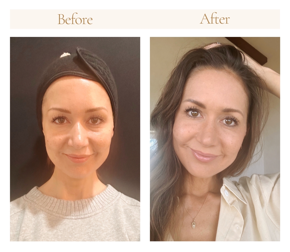 I Tried Emface, a Needle-Free Alternative to Filler—Here's My Honest Review